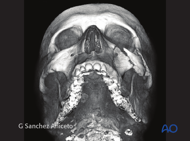 Orbitozygomatic osteotomy for Zygoma malposition
