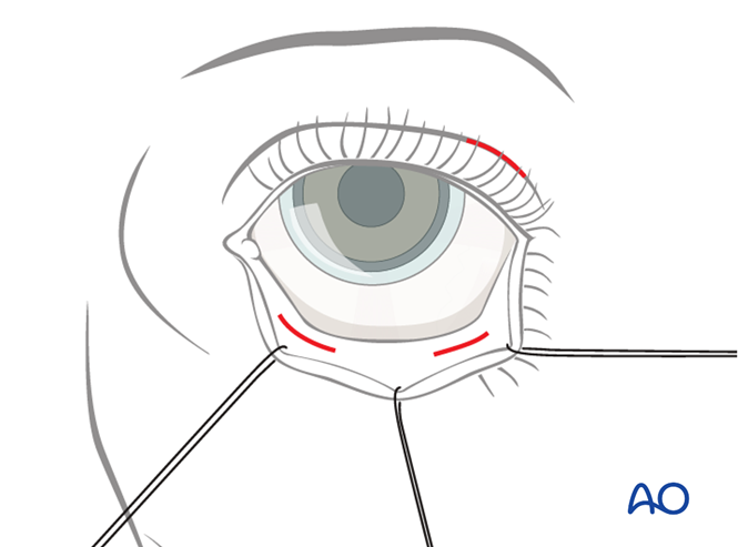 Intraorbital volume augmentation for Orbital wall defects