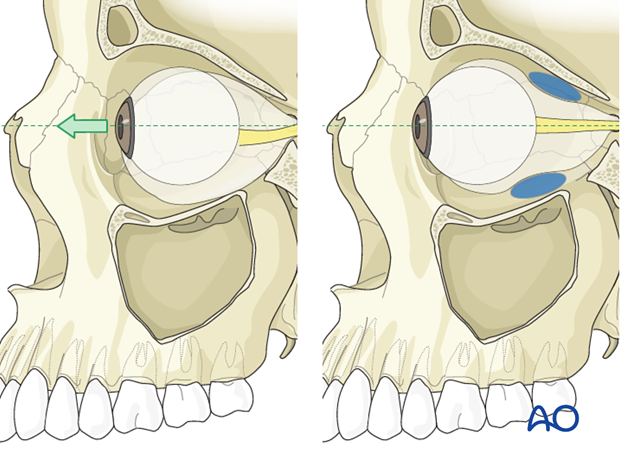 Intraorbital volume augmentation for Orbital wall defects