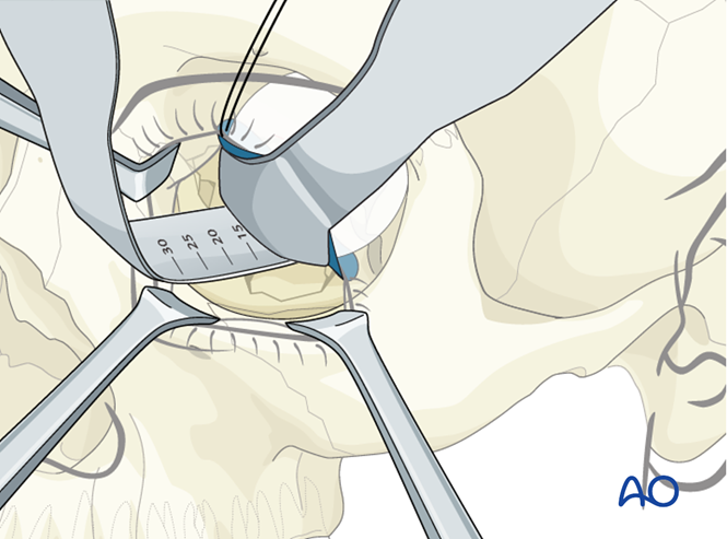 Reconstruction of orbital floor/wall defects for Orbital wall defects