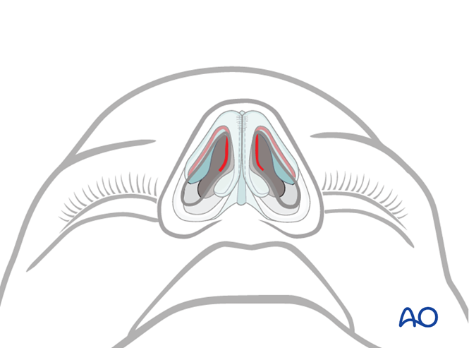 Nasal lengthening for External nasal deformities