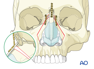 Nasal lengthening for External nasal deformities