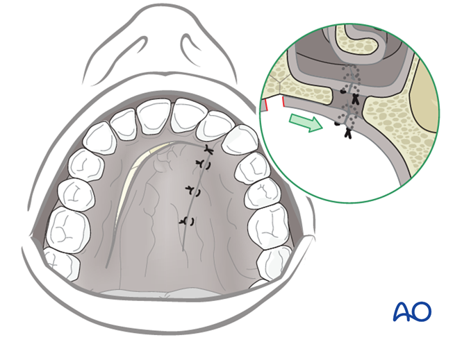 Closure with local tissue for Oronasal / Oroantral Fistulae