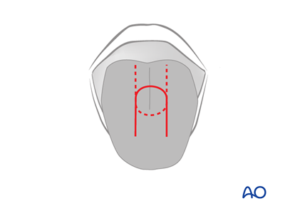 Tongue flap for Oronasal / Oroantral Fistulae