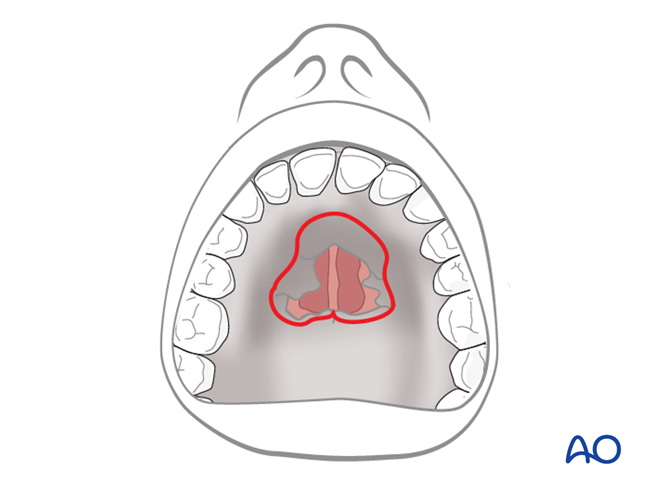 Tongue flap for Oronasal / Oroantral Fistulae