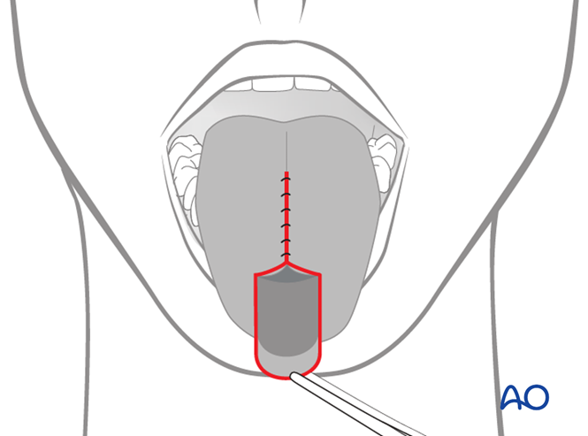 Tongue flap for Oronasal / Oroantral Fistulae