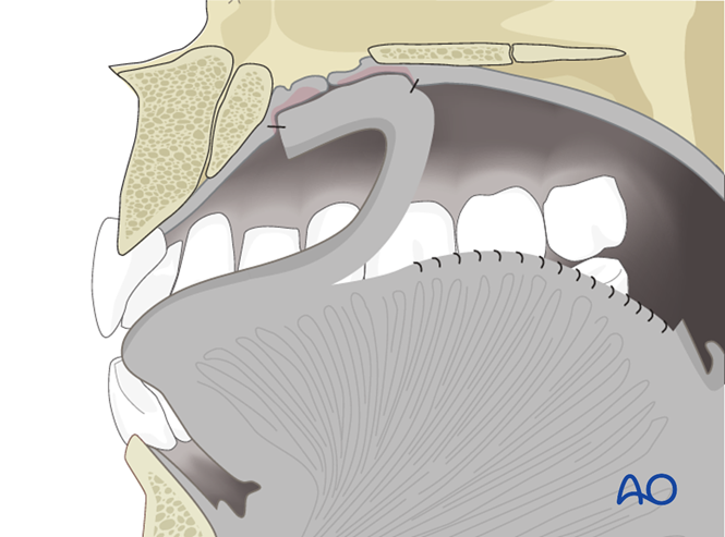 Tongue flap for Oronasal / Oroantral Fistulae