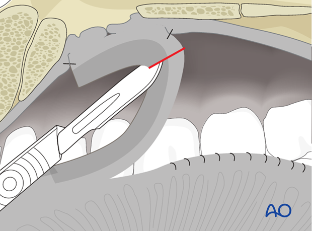 Tongue flap for Oronasal / Oroantral Fistulae