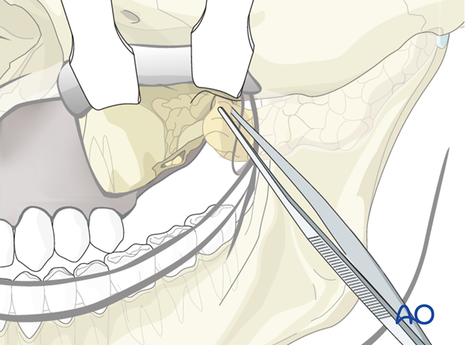 Buccal fat pad for Oronasal / Oroantral Fistulae