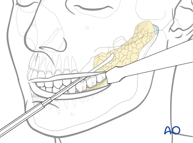 Buccal fat pad for Alveolar defects in the maxilla