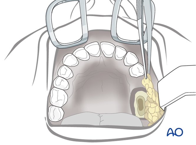 Buccal fat pad for Alveolar defects in the maxilla
