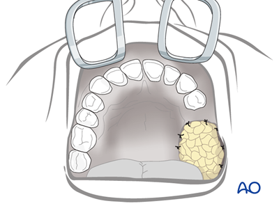 Buccal fat pad for Alveolar defects in the maxilla