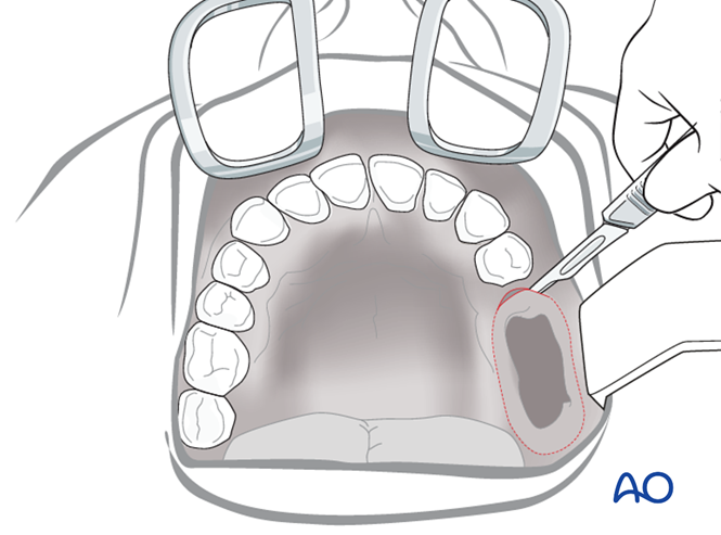 Temporalis muscle flap for Oronasal / Oroantral Fistulae