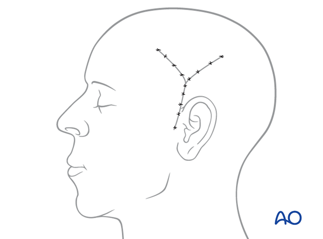 Temporalis muscle flap for Oronasal / Oroantral Fistulae
