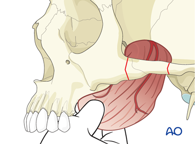 Temporalis muscle flap for Oronasal / Oroantral Fistulae