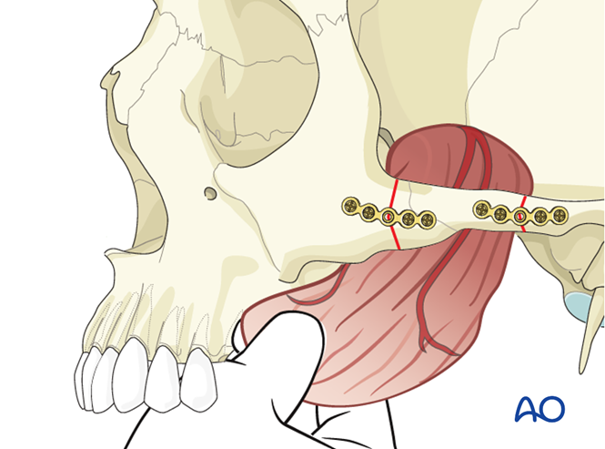 Temporalis muscle flap for Oronasal / Oroantral Fistulae
