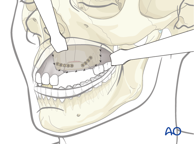 Non-vascularized bone for Alveolar defects in the maxilla
