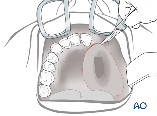 Fibula osteocutaneous flap for Alveolar defects in the maxilla