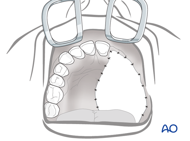 Radial forearm free flap for Alveolar defects in the maxilla