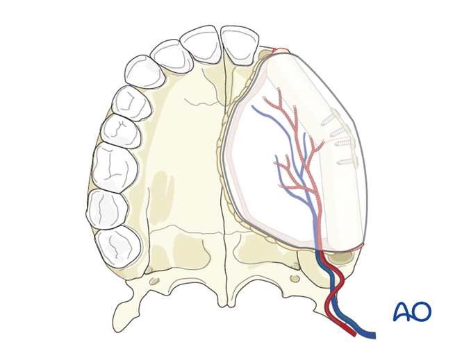 Fibula osteocutaneous flap for Alveolar defects in the maxilla