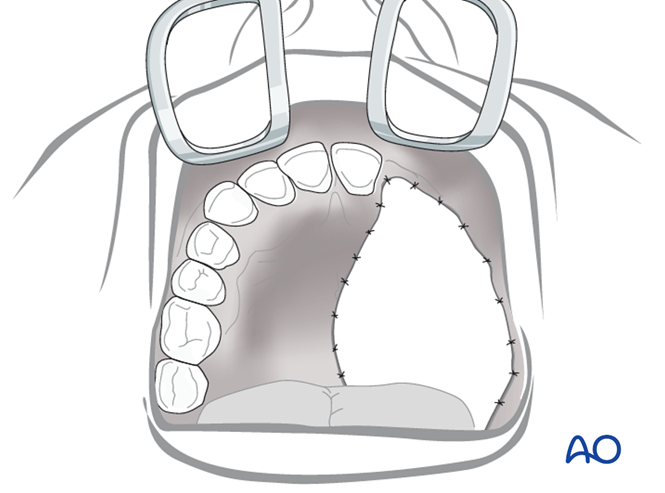 Fibula osteocutaneous flap for Alveolar defects in the maxilla