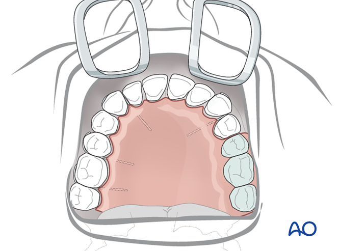 Obturator for Alveolar defects in the maxilla