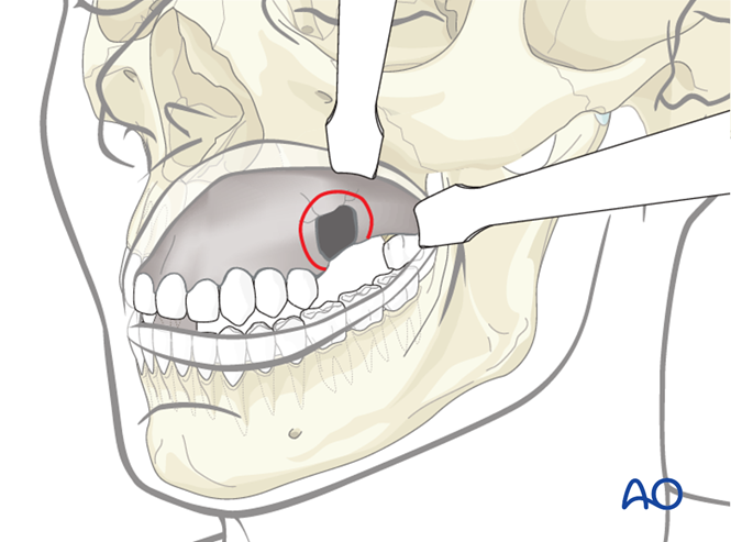 FAMM Flap for Alveolar defects in the maxilla