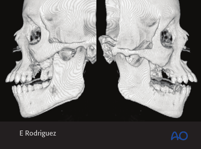 FAMM Flap for Alveolar defects in the maxilla