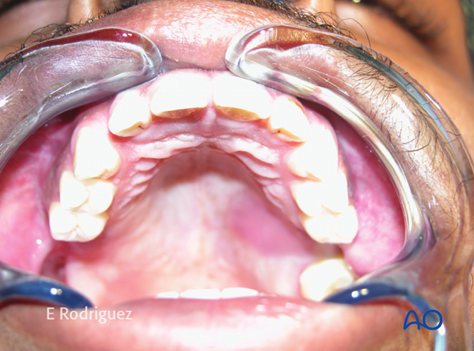 FAMM Flap for Alveolar defects in the maxilla