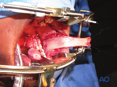 FAMM Flap for Alveolar defects in the maxilla