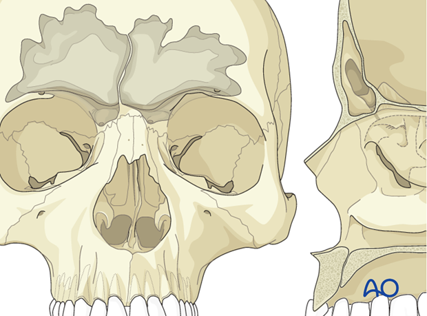Cranialization for Sinus outflow disease