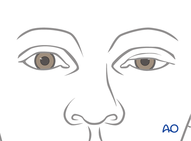 Examination of patients with midfacial post traumatic deformities