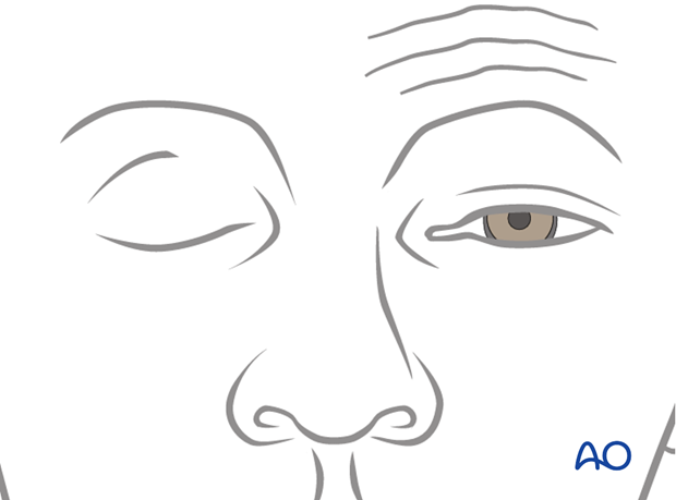 Examination of patients with midfacial post traumatic deformities