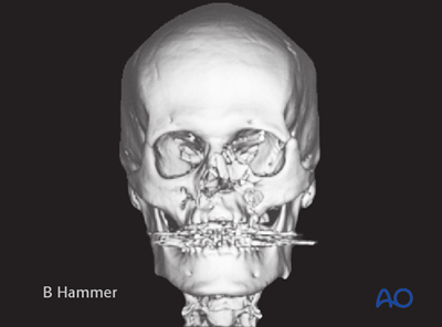 Examination of patients with midfacial post traumatic deformities