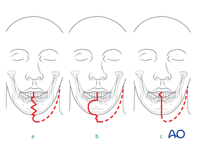 Lip split approach to the mandible