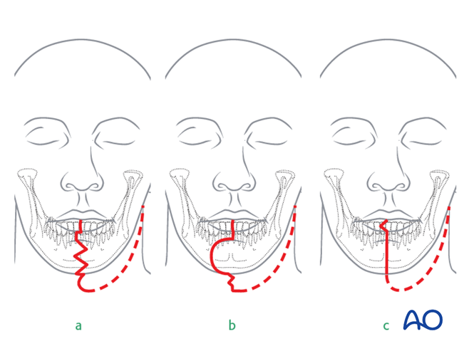 Lip split approach to the mandible