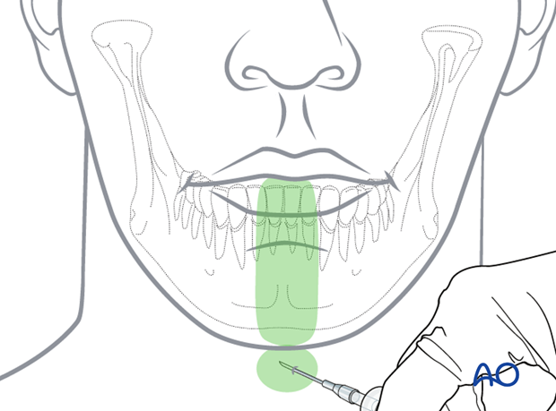 Lip split approach to the mandible