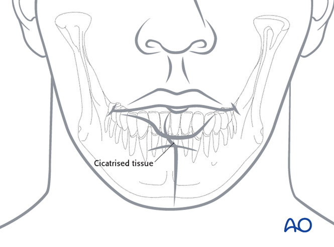 Lip split approach to the mandible