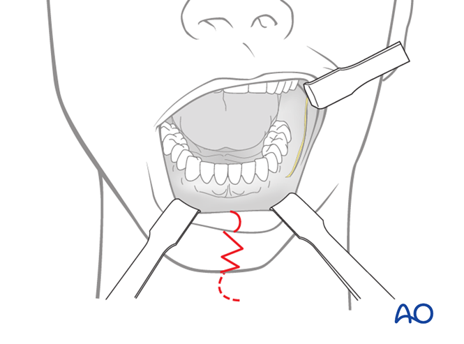 Lip split approach to the mandible