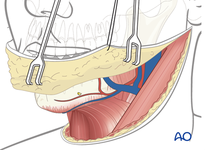 Lip split approach to the mandible