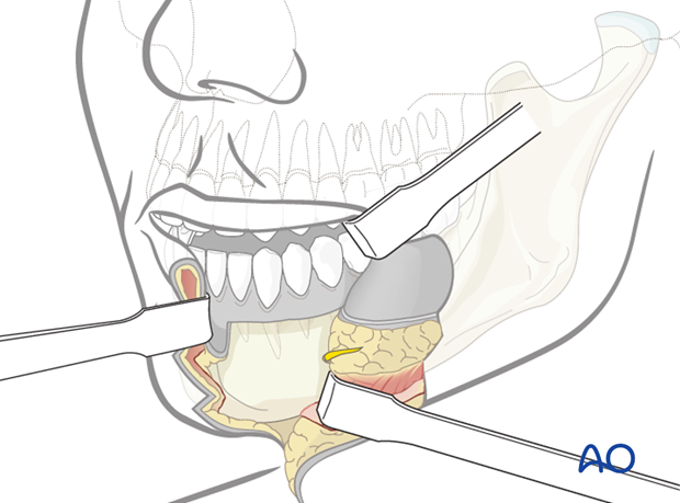 Lip split approach to the mandible
