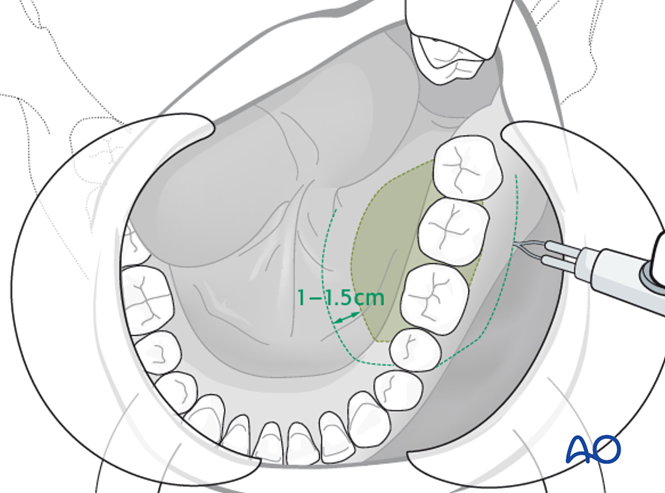 Visor approach approach to the mandible