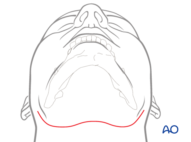 Visor approach approach to the mandible