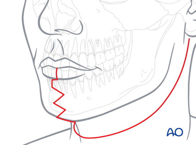 Lip split approach to the mandible