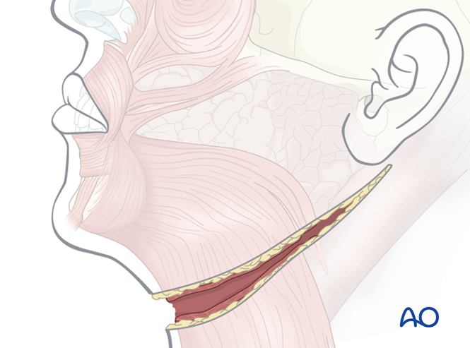 Visor approach approach to the mandible