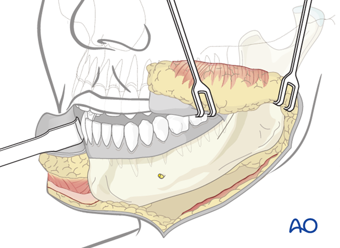 Lip split approach to the mandible