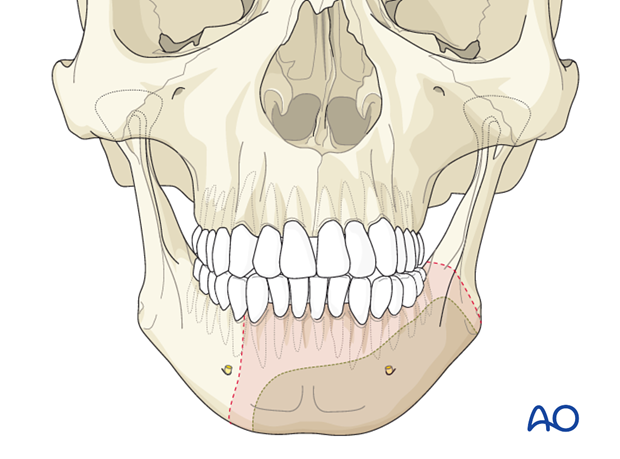 Lip split approach to the mandible