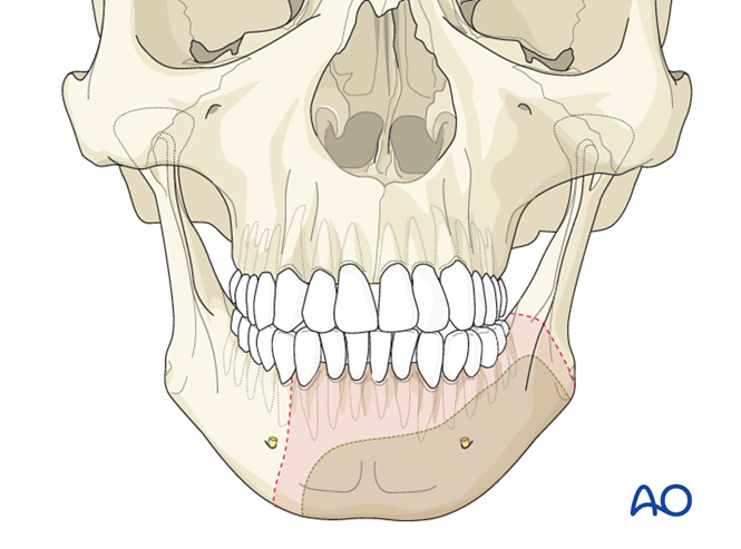 Lip split approach to the mandible