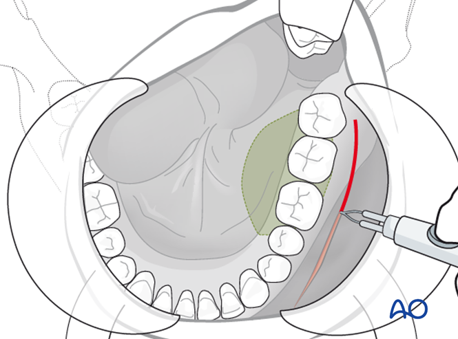 Visor approach approach to the mandible
