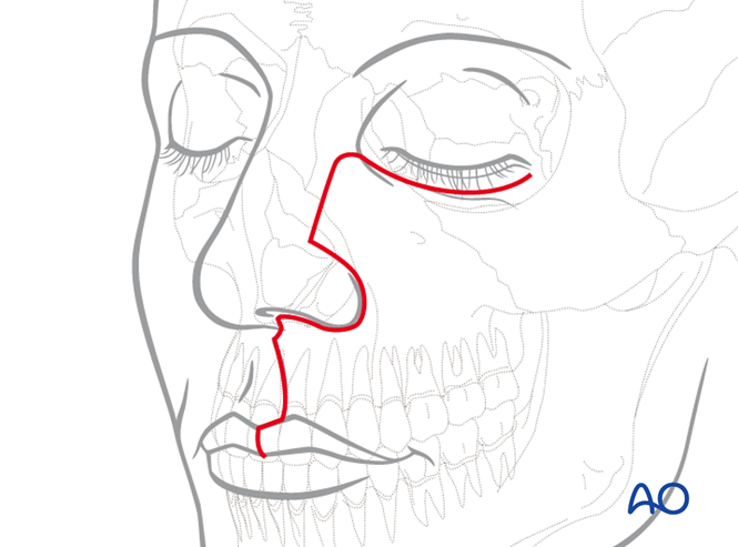 Weber Ferguson approach